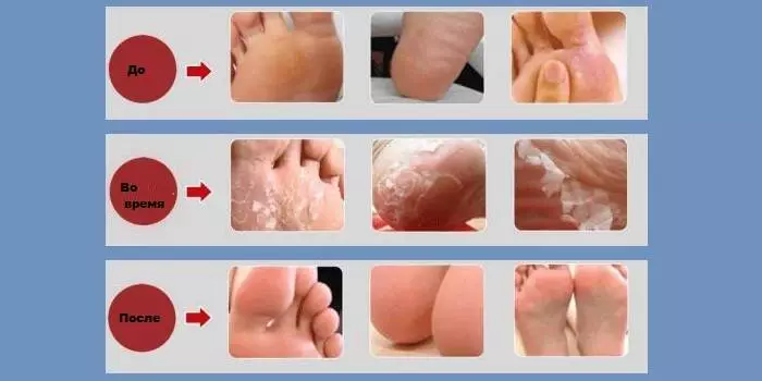 Picioarele înainte, în timpul și după peelingul mecanic