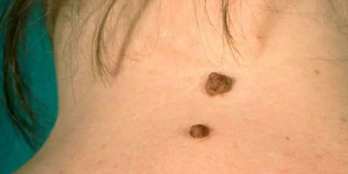 Melanomas on the girl's neck