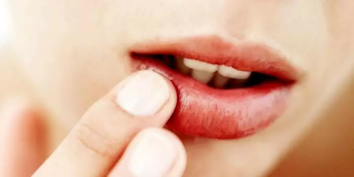 Das Mädchen schmiert mit Salbe den von Herpes betroffenen Bereich der Lippe