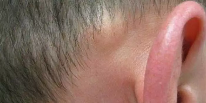 Vaikinas turi fibromą už ausies