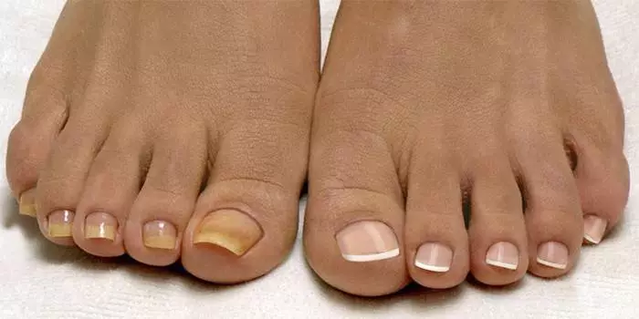 Zdravi nohti na nogah in rokah, prizadeti z glivicami