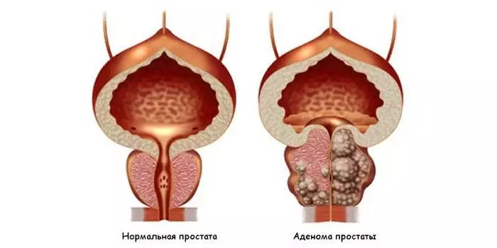 Adenoma prostate sy prostate mahasalama