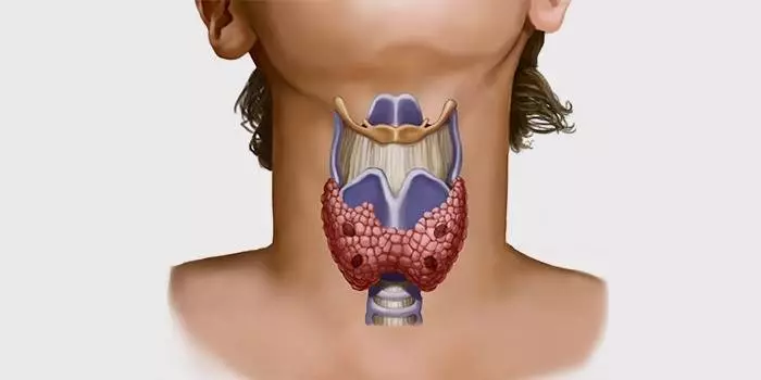 Cov thyroid hypothyroidism