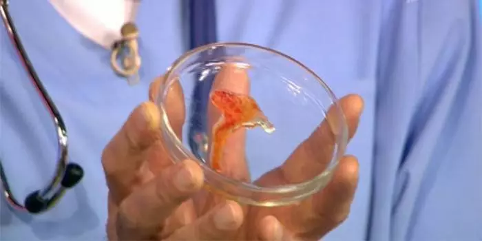 Ein Sanitäter hält eine Petrischale mit Auswurf eines Tuberkulosepatienten