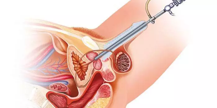 經尿道前列腺電切術方案