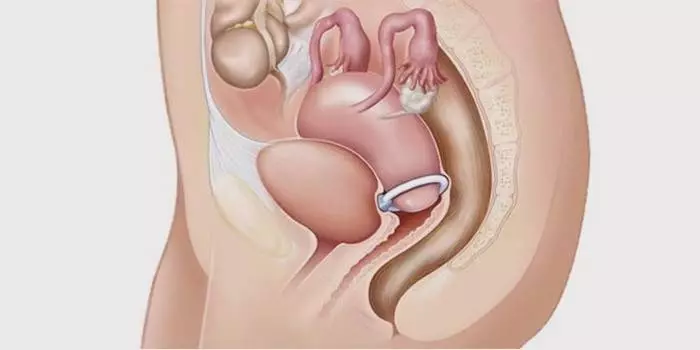 Pessário no colo do útero