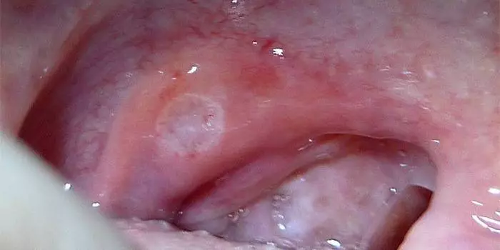 Muujinta stomatitis