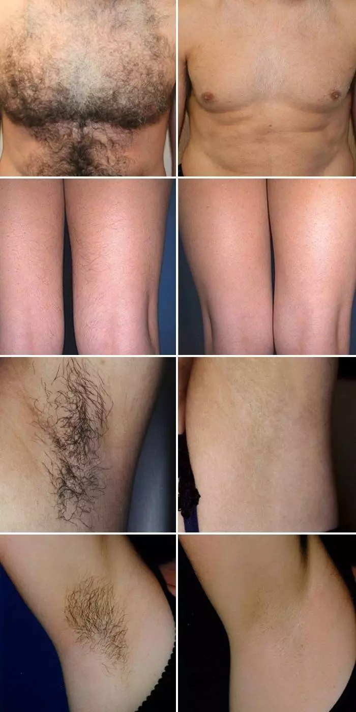 එලෝස් epilation කිරීමට පෙර සහ පසු ඡායාරූප