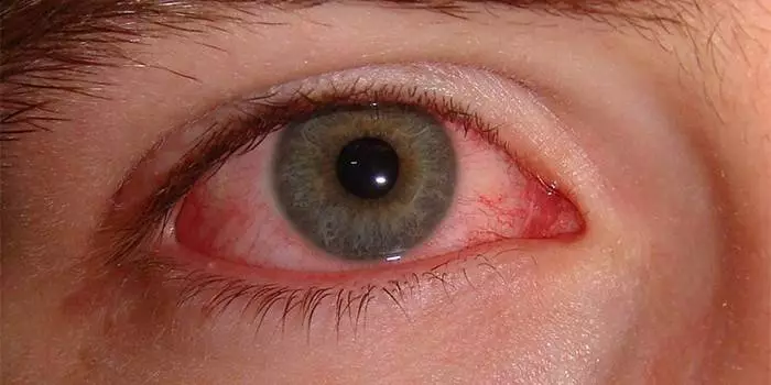 Fungus-affected human eye