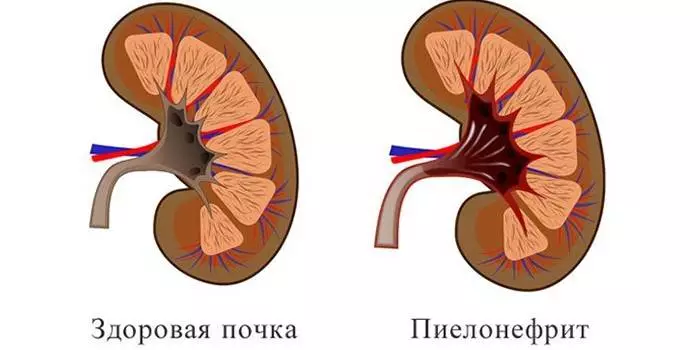 Diagram fan in sûne en ûntstoken minsklike nier