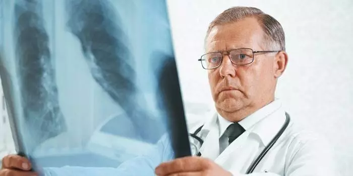 The doctor examines the x-ray of the lungs