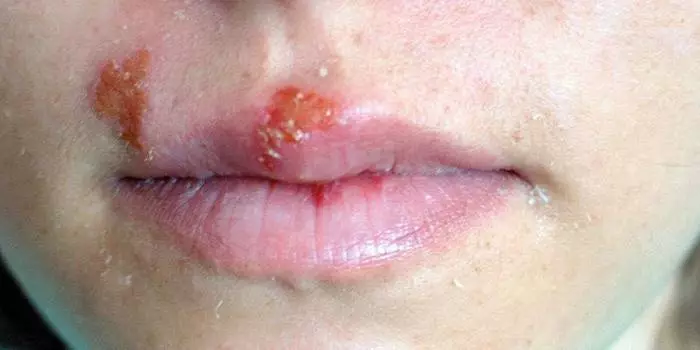 Herpes on the girl's upper lip
