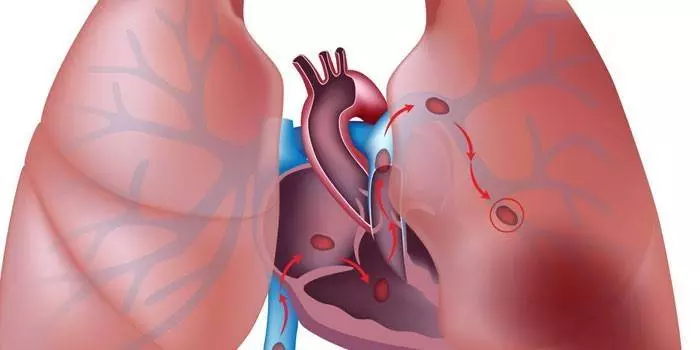 Pulmonale hipertensie diagram