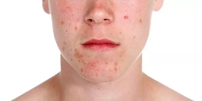 Acne i ansigtet