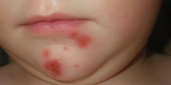 Herpes im Gesicht eines Kindes