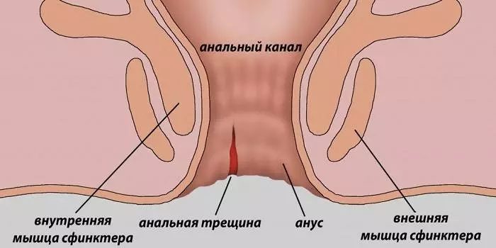 Fissure furo