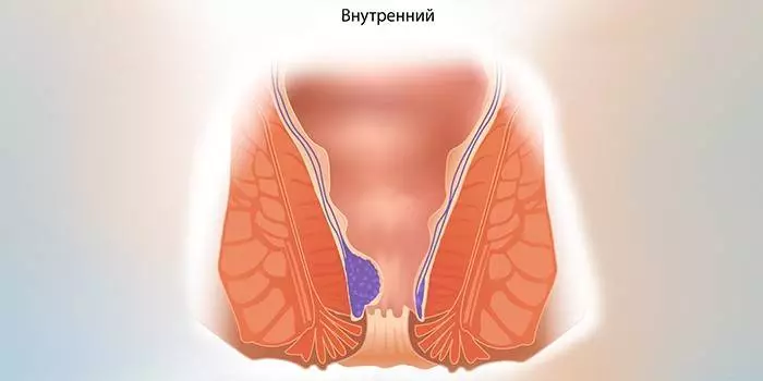 Ti abẹnu fọọmu ti hemorrhoids