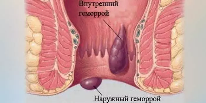 Apapo fọọmu ti hemorrhoids