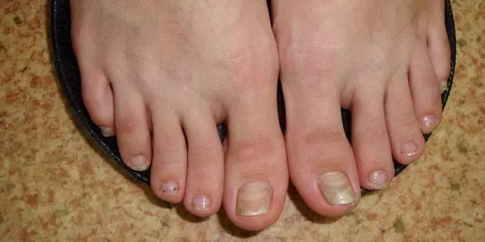 پير متاثر ٿيا onychomycosis کان