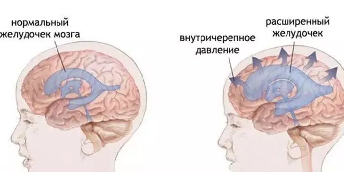 Normal beyin diyagramı ve kafa içi basıncındaki değişiklikler