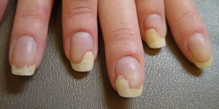 Manifestation of nail fungus on the hands