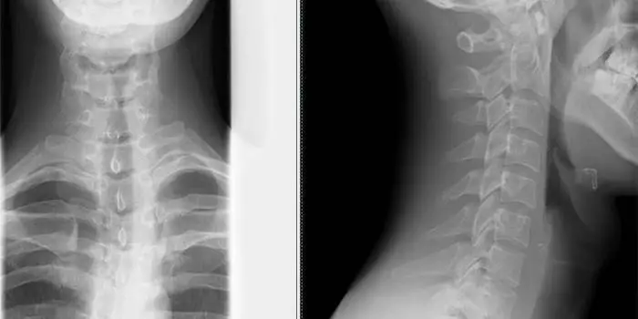 Gimdos kaklelio stuburo rentgeno nuotrauka