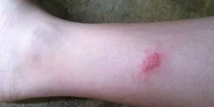 Manifestations of herpes on the skin of the leg
