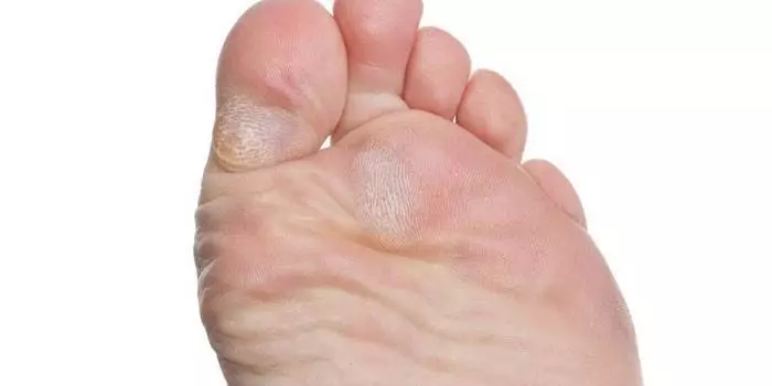 Mycosis của bàn chân