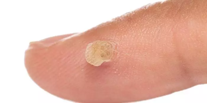 Papilloma on the finger