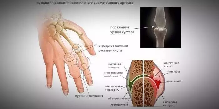 Оштетување на зглобовите на раката