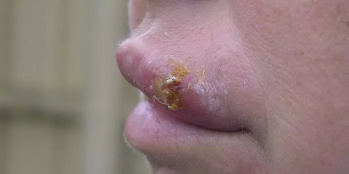 Herpes simplex lori aaye