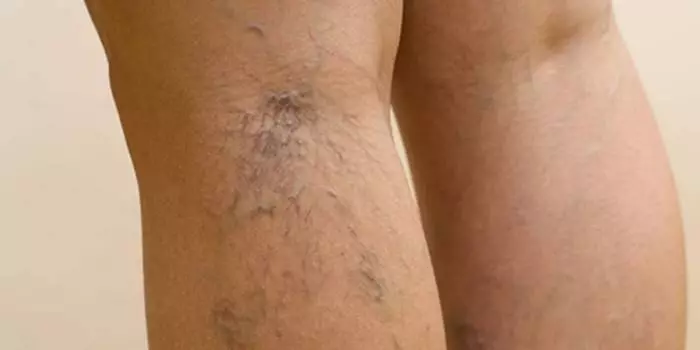 Varicose veins in the legs