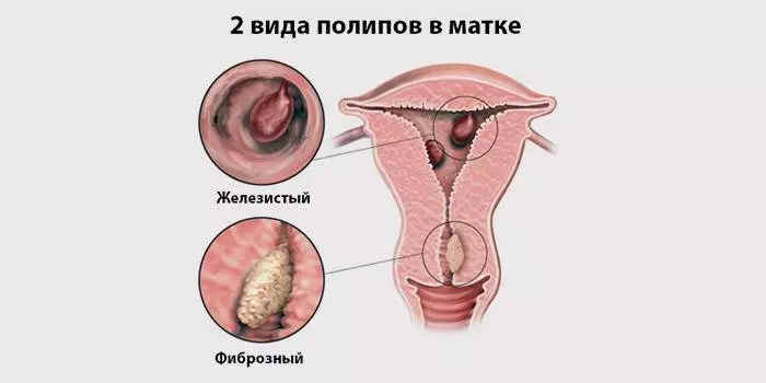 Polyps san uterus, comharthaí agus cóireáil le leigheasanna tíre