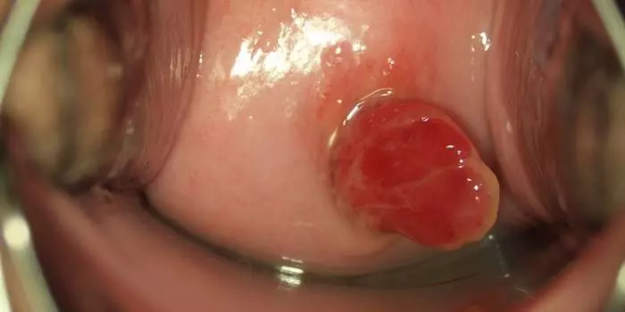 Polyp san uterus