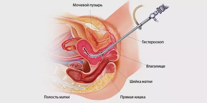 Премахване на полипи в матката