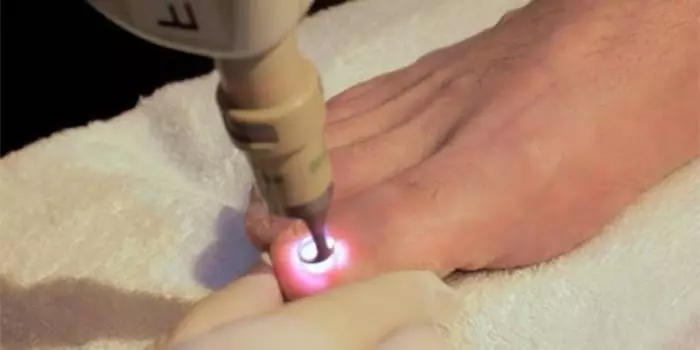 Remoção da lâmina ungueal com laser