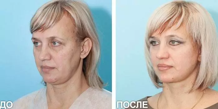 Foto seorang wanita sebelum dan selepas mengangkat SMAS