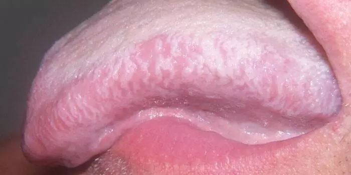 Leukoplakia op 'e tonge