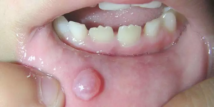 stomatitis Herpetic