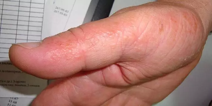 I-Dyshidrotic eczema