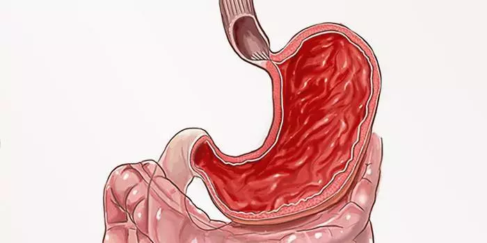 Gastritis pamufananidzo