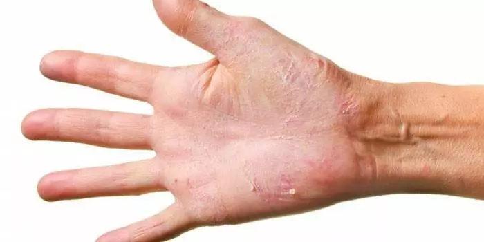 Dermatomikosis di tangan