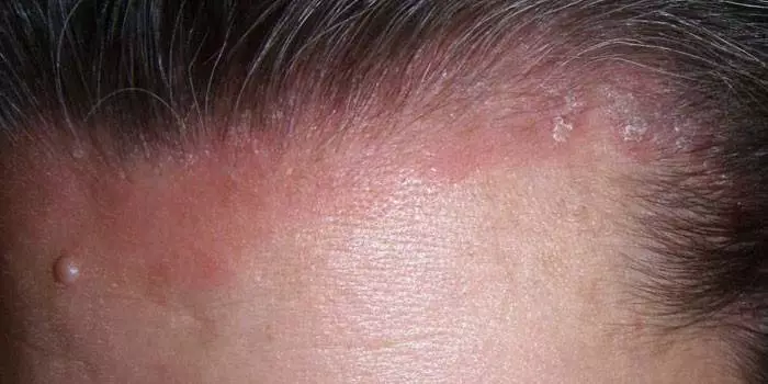 Mycosis of the scalp