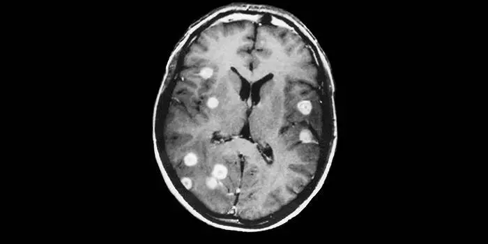 Metástasis cerebrais