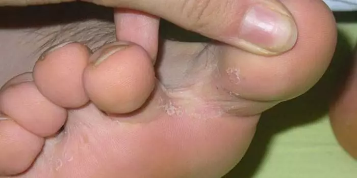 Fungus between the toes