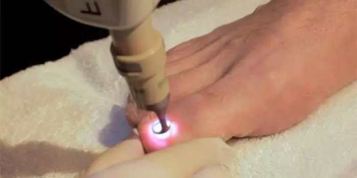 Laserbehandeling