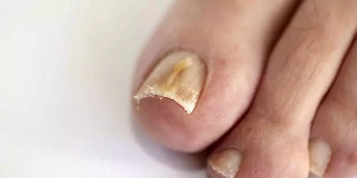 Unhas afectadas por fungos