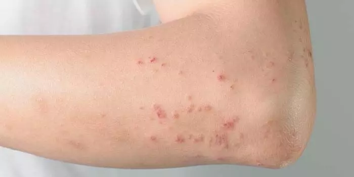 Urticaria alérgica en el brazo.