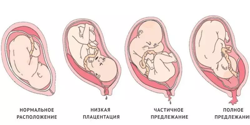 前置胎盤の種類