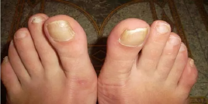 Unhas dos pés afectadas
